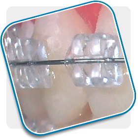 Prada Ortondoncistas :: Frenillos & Brackets